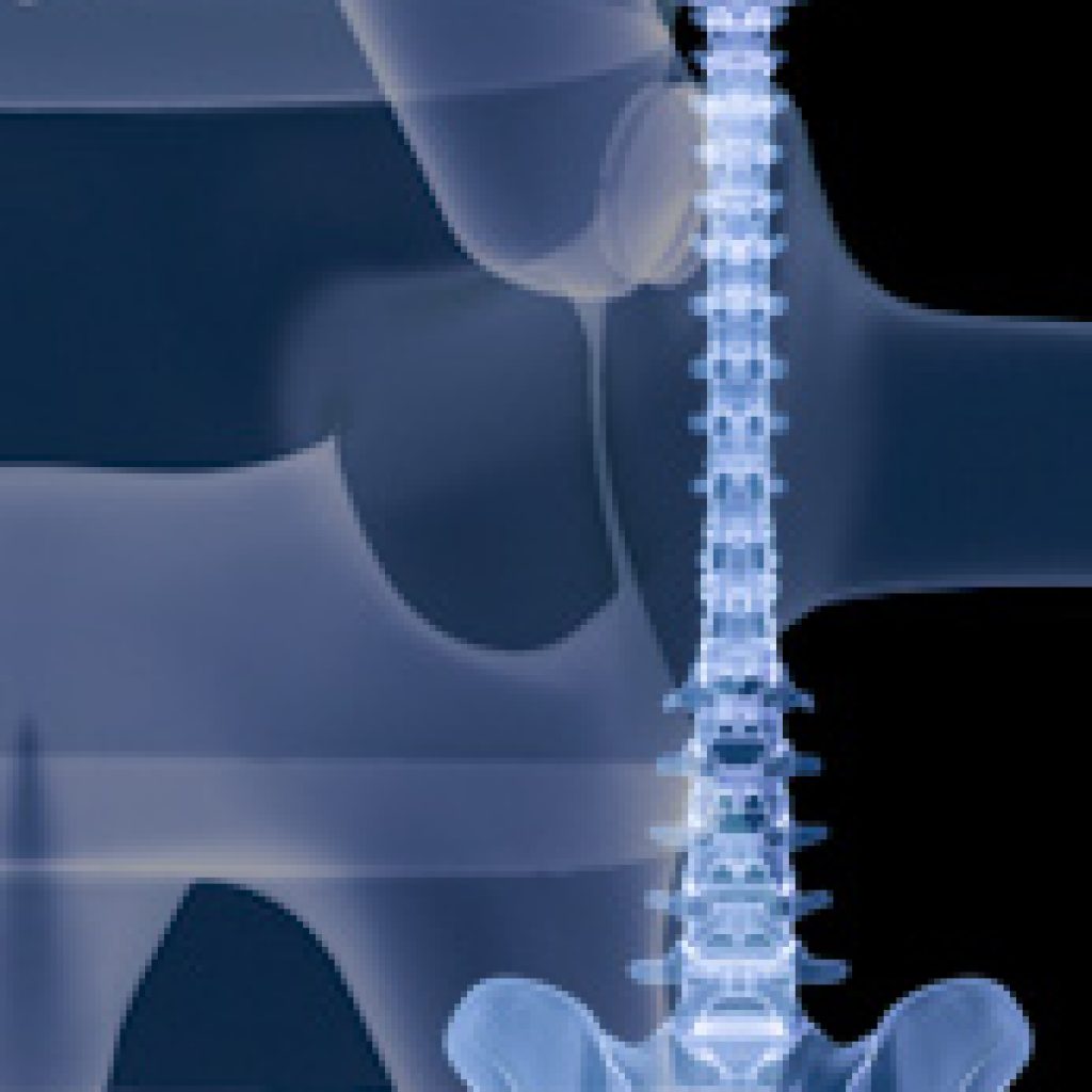 Kyphoplasty | New Jersey Spine Specialists