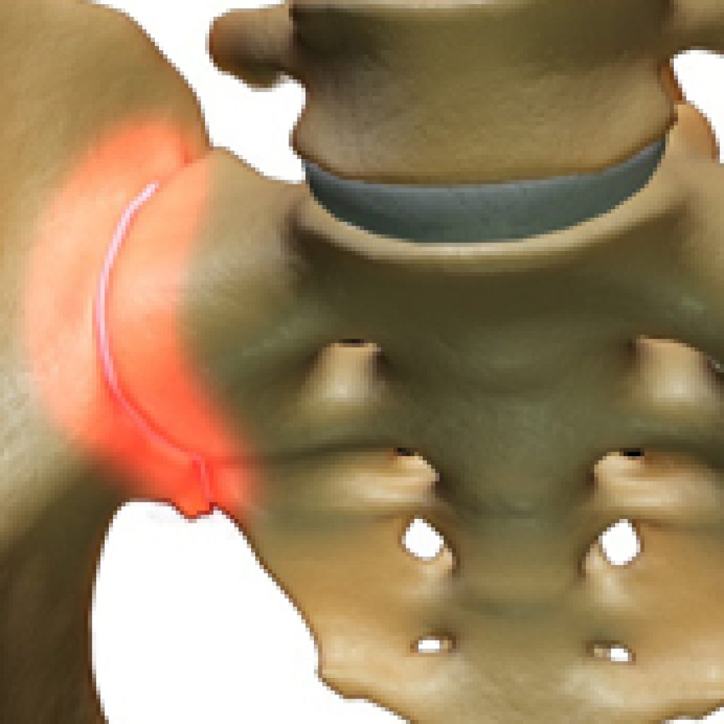 Sacroiliitis | New Jersey Spine Specialists